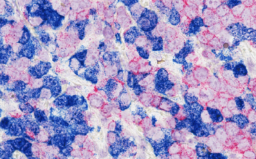 PreciseDx Secures $20.7M to Advance AI-Powered Breast Cancer Risk ...